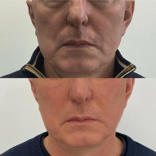 Facelift / Lifting twarzy | Dominik Boliglowa